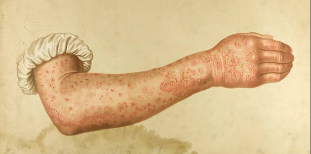 Angry Skin | The Point Magazine